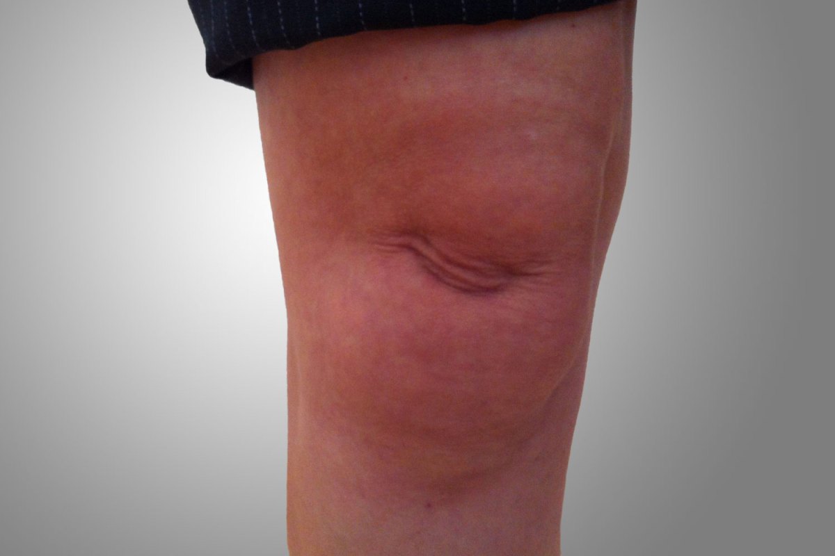 Infrapatellar Fat Pad Syndrome - Best Physiotherapy in Newmarket