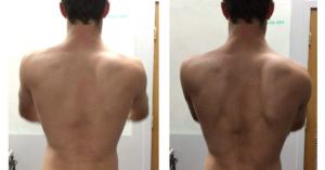 Scapular Dyskinesis Treatment - Physiotherapy Clinic Newmarket