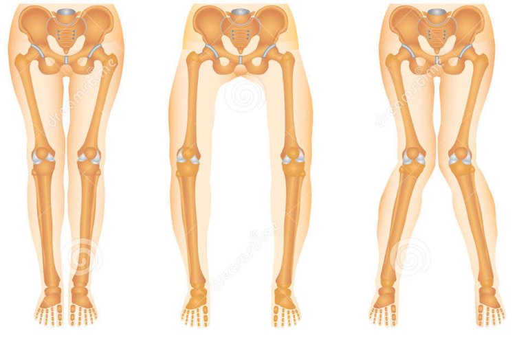 Genu Valgum(Cross Leg) Best Way of Treatment
